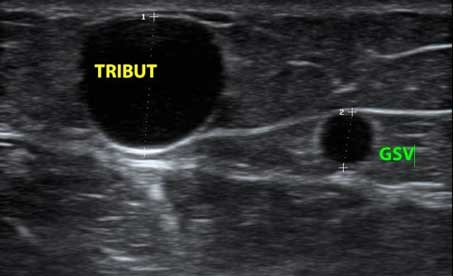 Echo-Doppler Des Veines – Chirurgien vasculaire – Dr Hamid CHANNANE